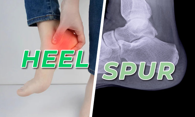 What is a Heel Spur? Symptoms, Causes & Treatments Explained — Feet&Feet